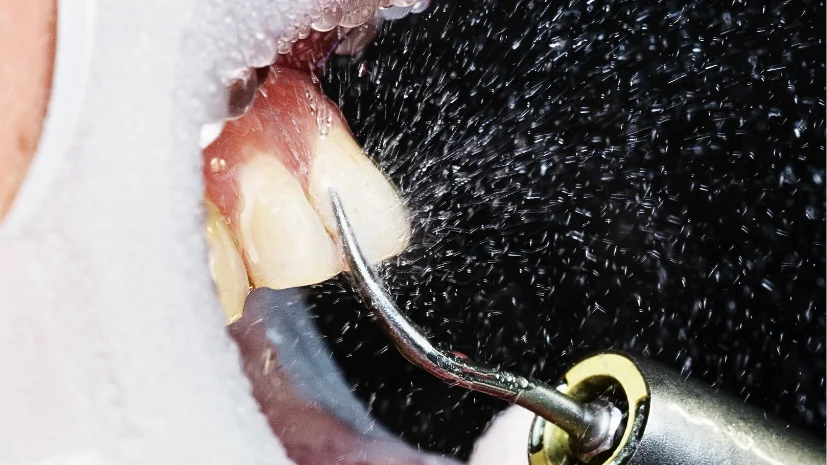 Mastering Denture Care with VEVOR's Ultrasonic Brilliance - VEVOR Blog